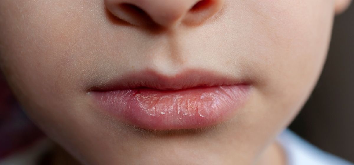 10 Cara Ampuh agar Bibir dan Kulit Tidak Kering saat Puasa | Blog Rey