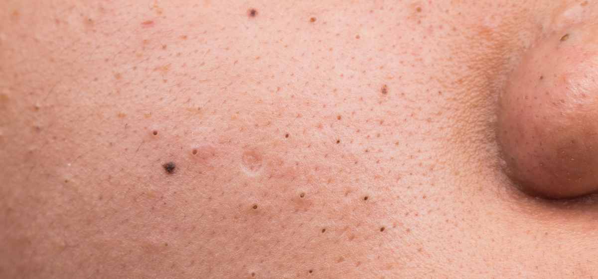 Alami! 10 Cara Menghilangkan Komedo di Hidung | Blog Rey