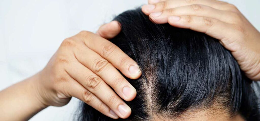 9 Manfaat Vitamin E untuk Rambut, Atasi Ketombe dan Rontok | Blog Rey