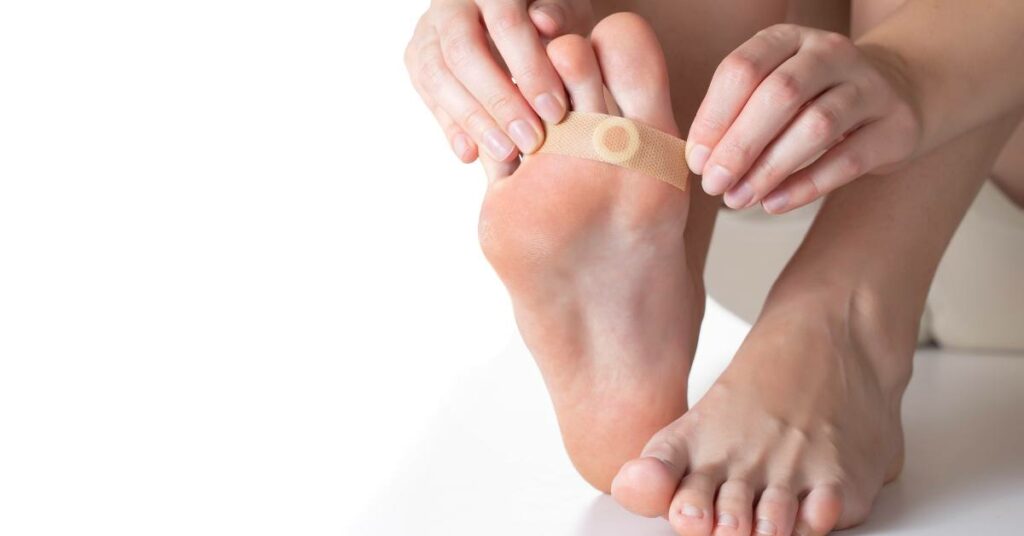 Penyakit Mata Ikan di Kaki: Penyebab, Gejala, Cara Mengobati | Blog Rey