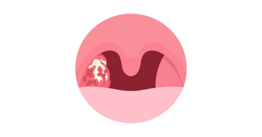 15+ Penyebab Benjolan di Leher, Wajib Periksa! | Blog Rey