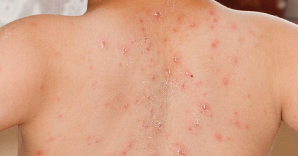7 Gejala Penyakit Rubella, Penyebab dan Pencegahannya | Blog Rey