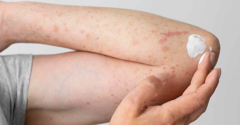 Penyakit Kurap: Penyebab, Gejala, Pengobatan dan Cara Mencegahnya ...